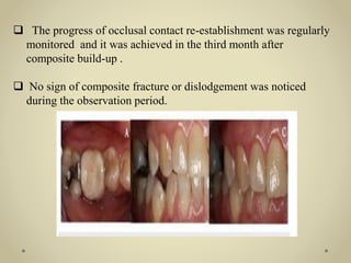 DAHL APPROACH a novel technique to raise bite | PPTX