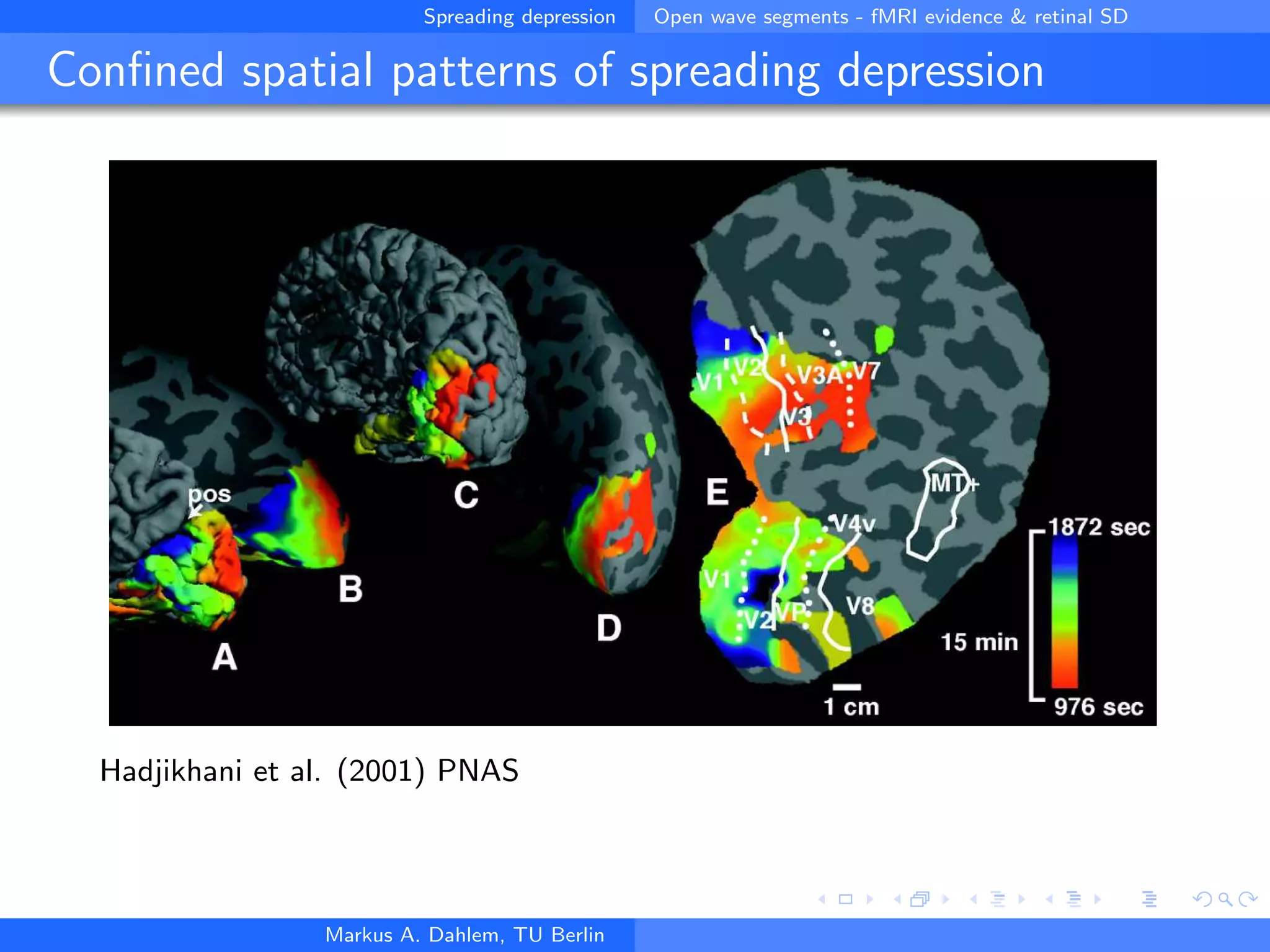 Reentrant and retracting waves of cortical spreading depression in ...