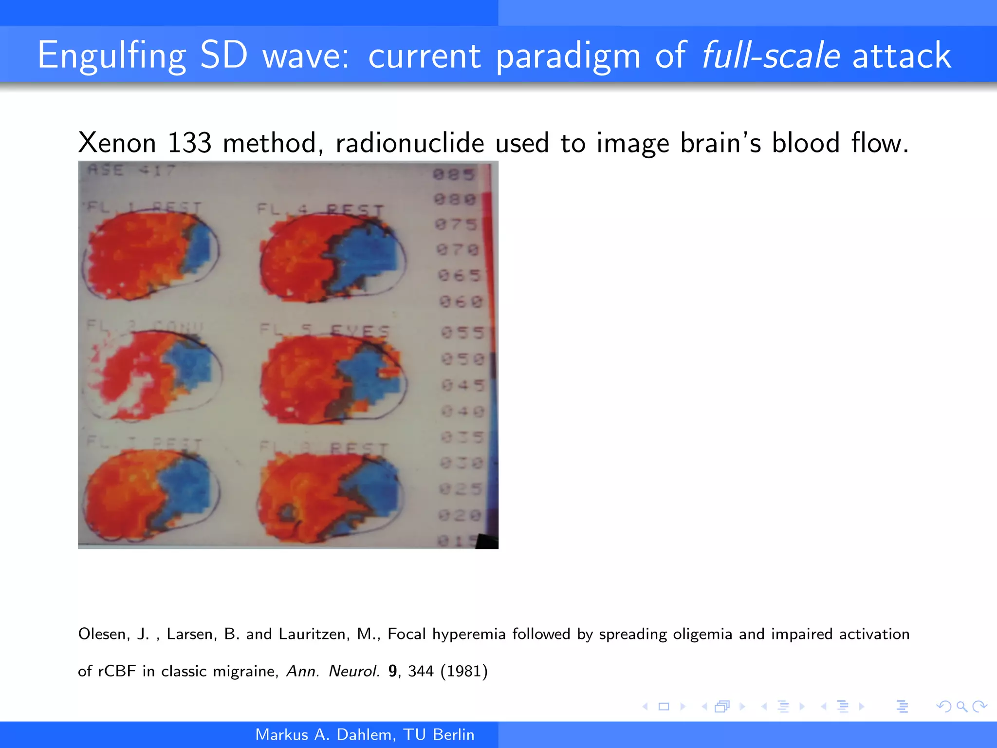 Localized transient waves of cortical spreading depression in migraine ...