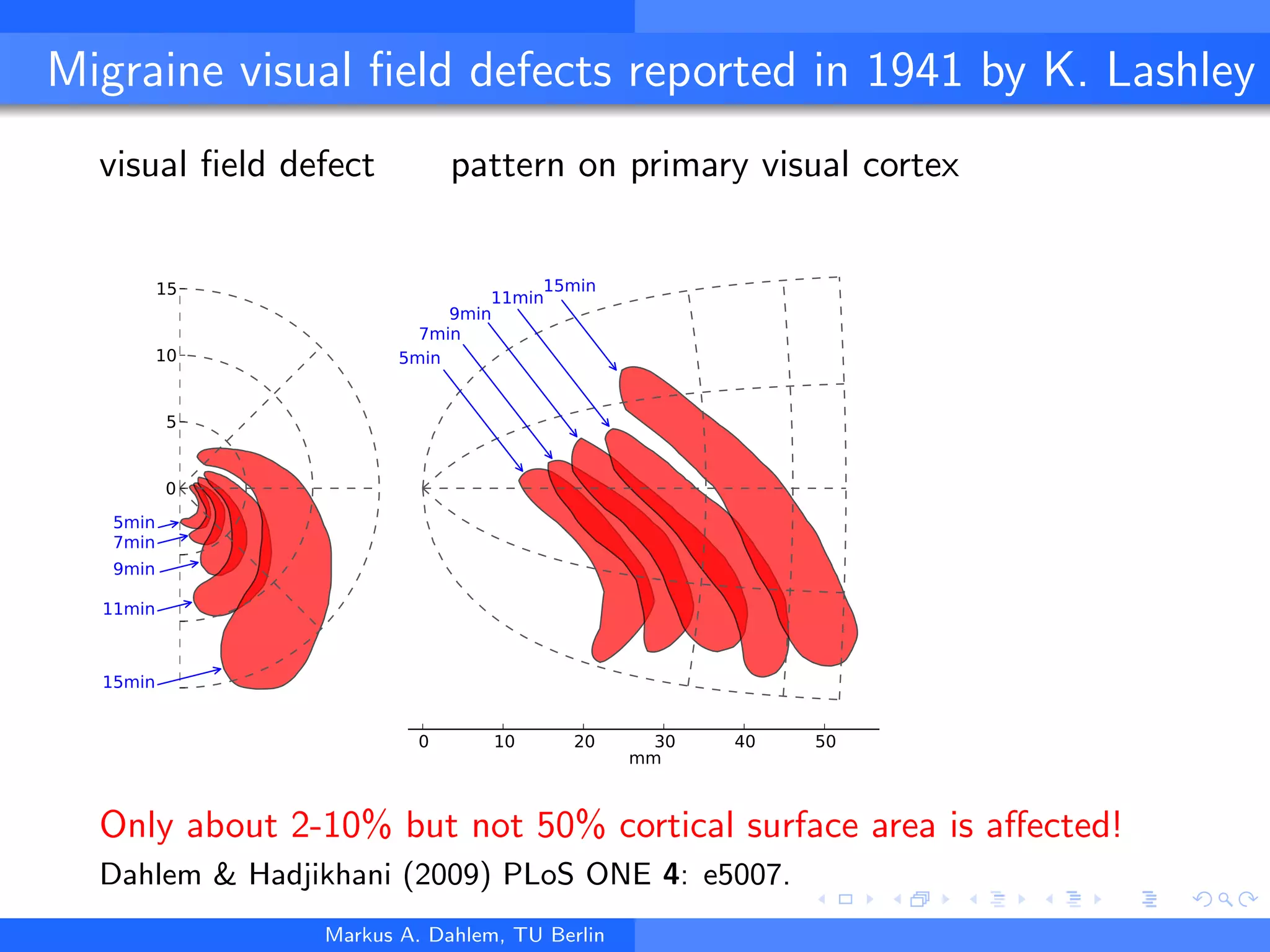 Localized transient waves of cortical spreading depression in migraine ...
