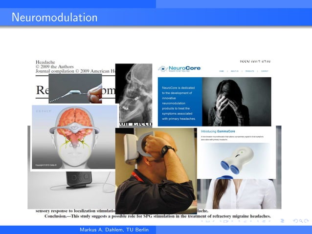 Localized transient waves of cortical spreading depression in migraine ...