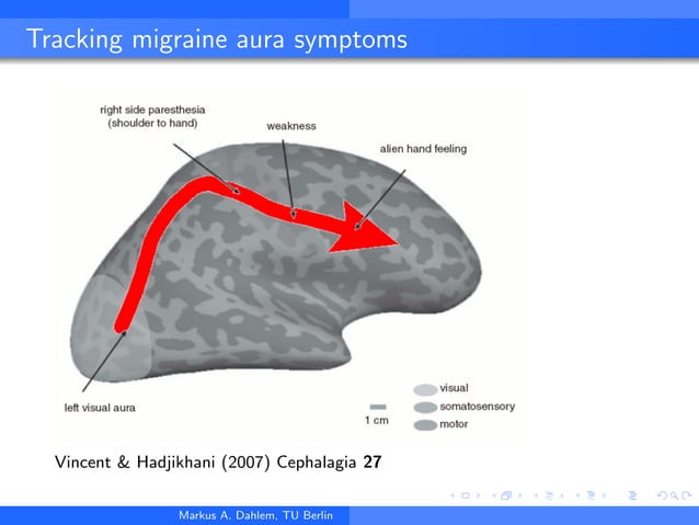 Localized transient waves of cortical spreading depression in migraine ...