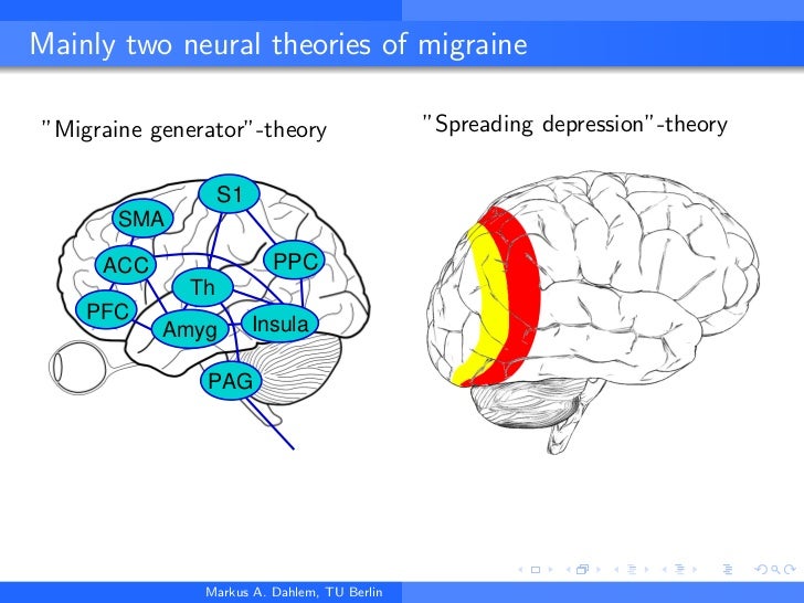 Localized transient waves of cortical spreading depression in migraine