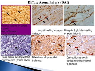 Diffuse axonal injury | PPTX | Death, Injury, or Military Conflict ...