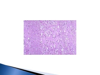 Diffuse Axonal Injury Histology
