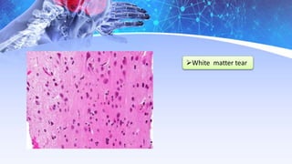 DIFFUSE AXONAL INJURY,CONCUSSION | PPT