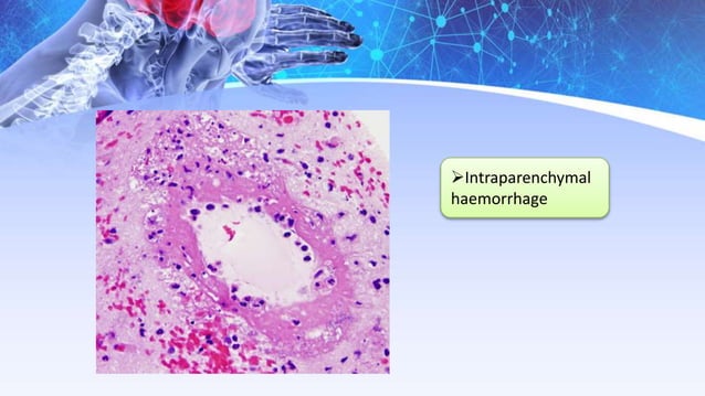 DIFFUSE AXONAL INJURY,CONCUSSION & CONTUSION | PPTX
