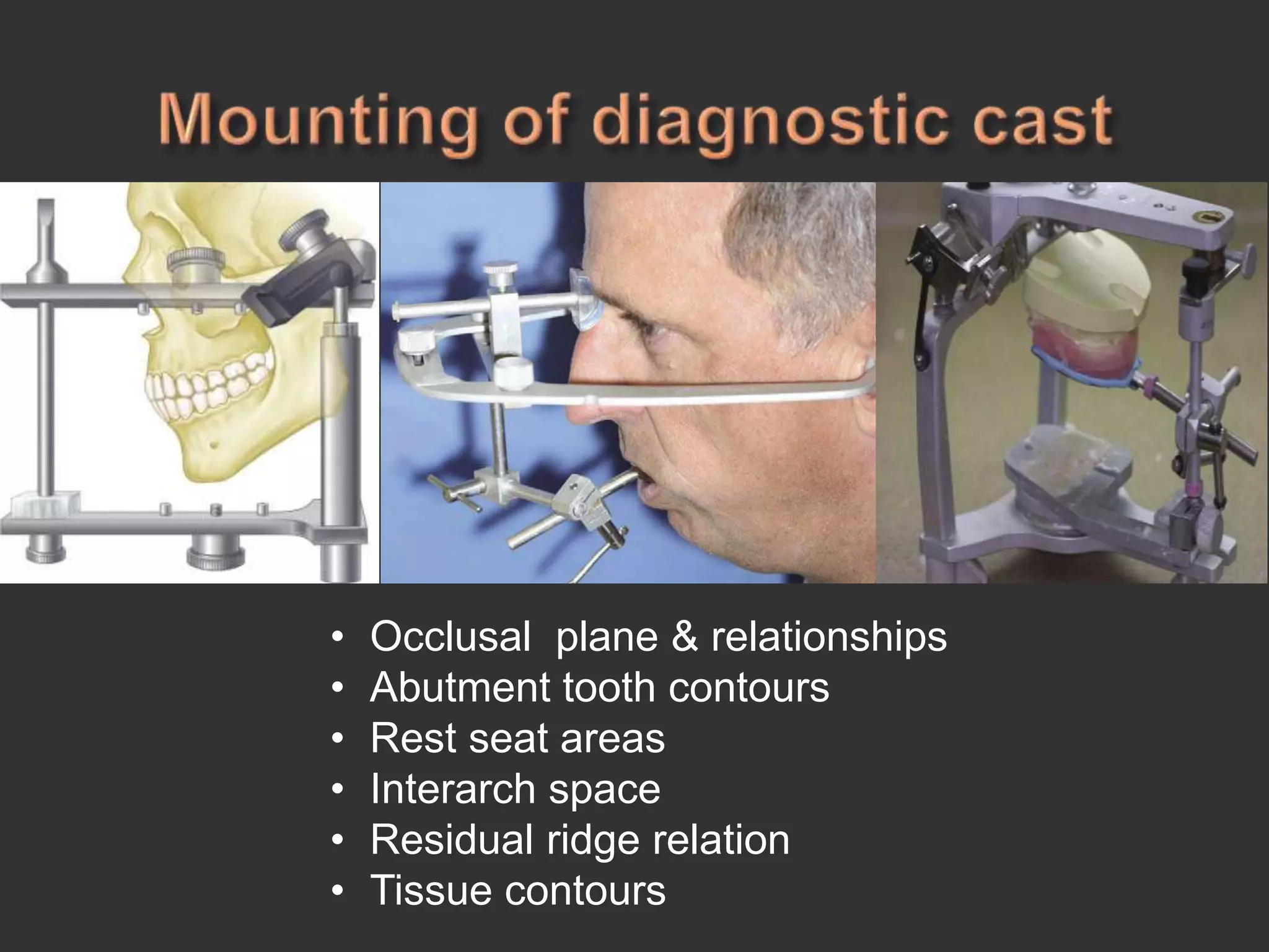 Diagnosis and treatment planning in removable partial denture | PPTX
