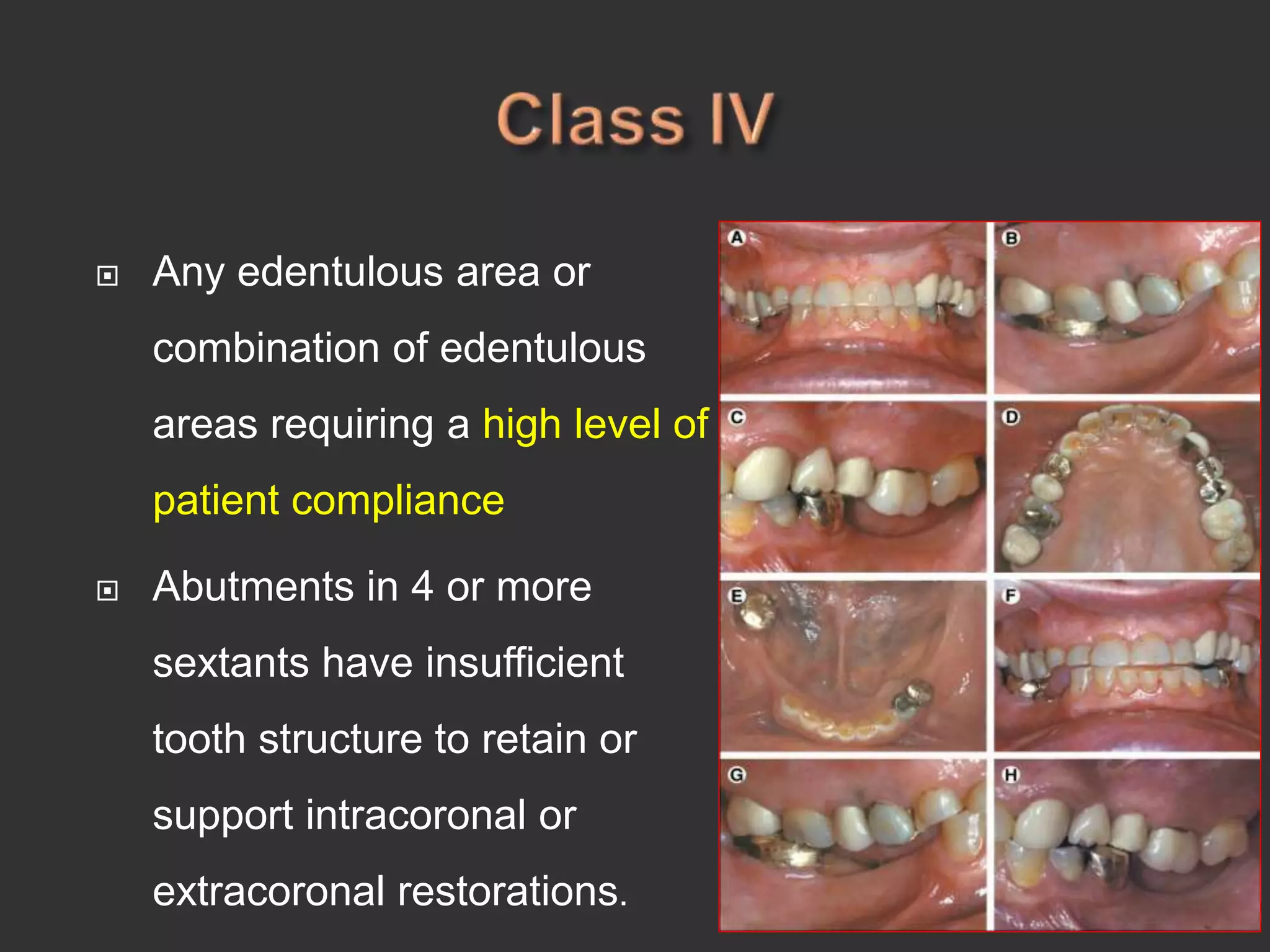 Diagnosis and treatment planning in removable partial denture | PPTX