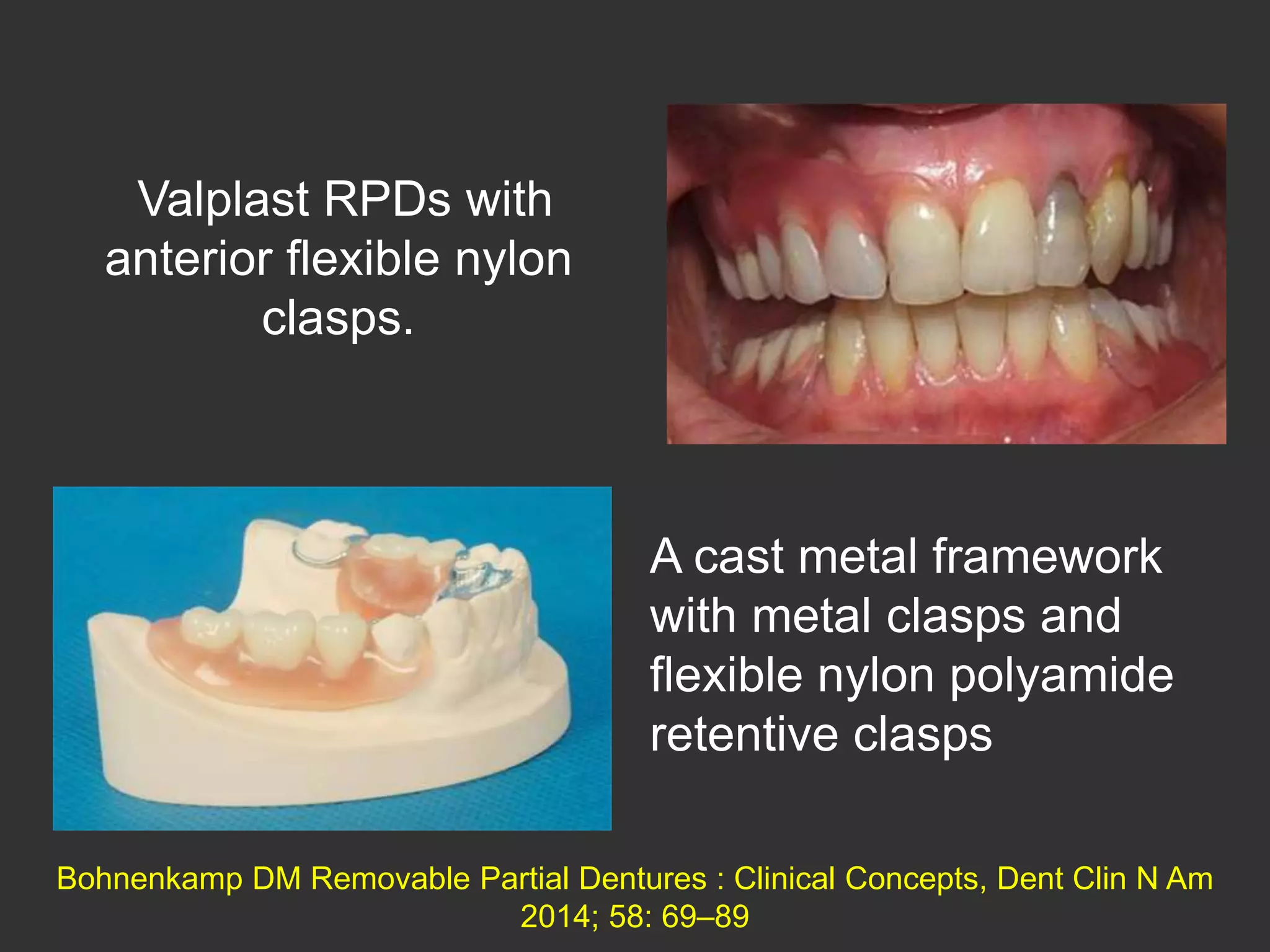Diagnosis and treatment planning in removable partial denture | PPTX