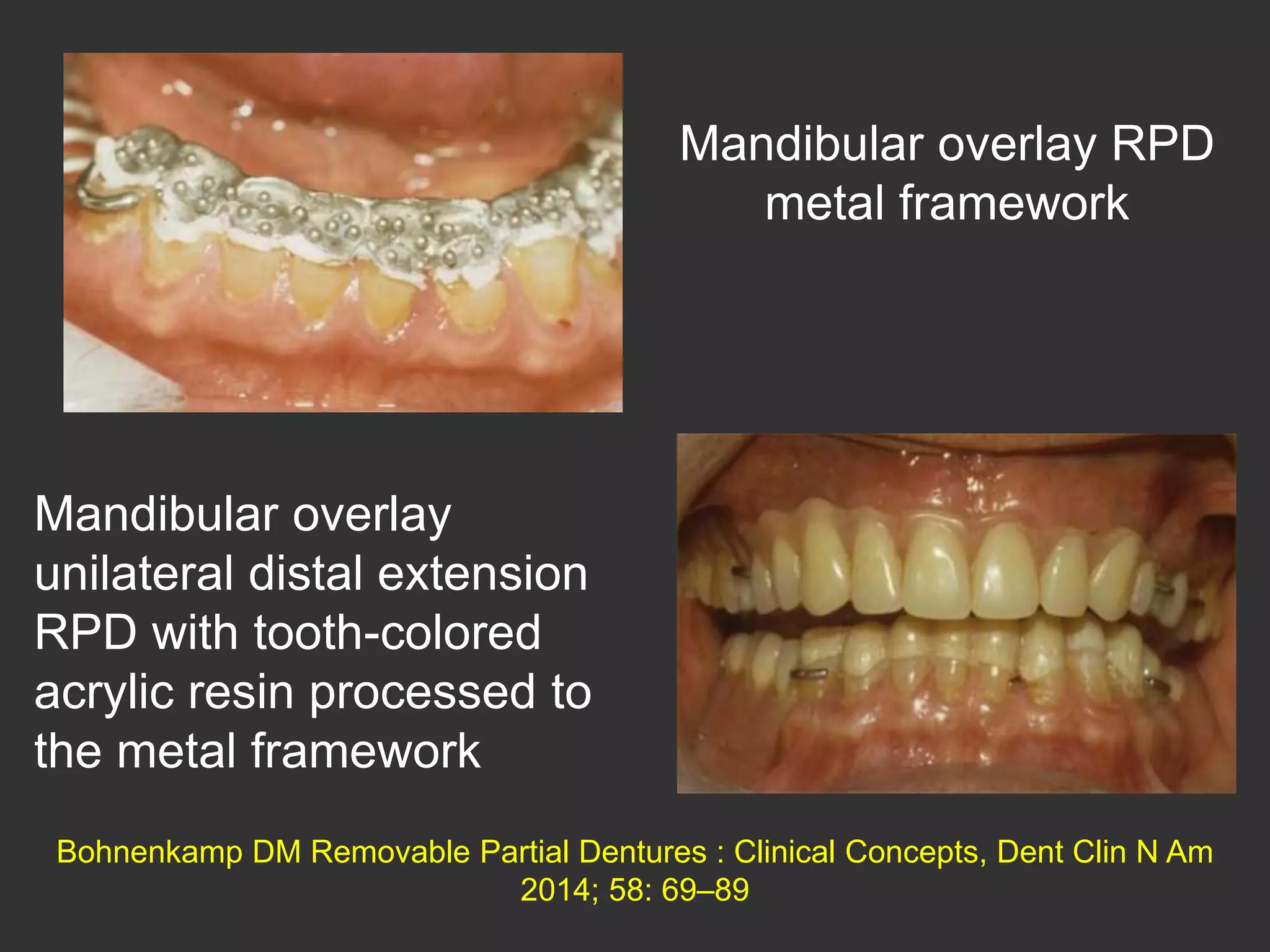Diagnosis and treatment planning in removable partial denture | PPTX