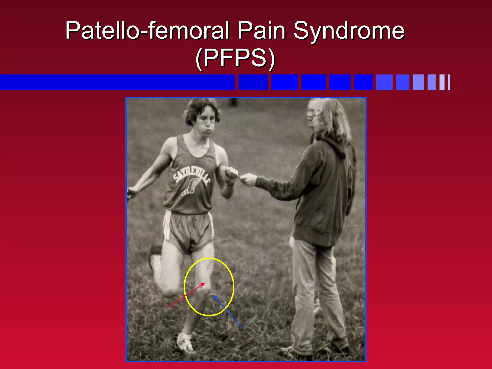 Current Concepts in Patellofemoral Pain Syndrome: Treatment and ...