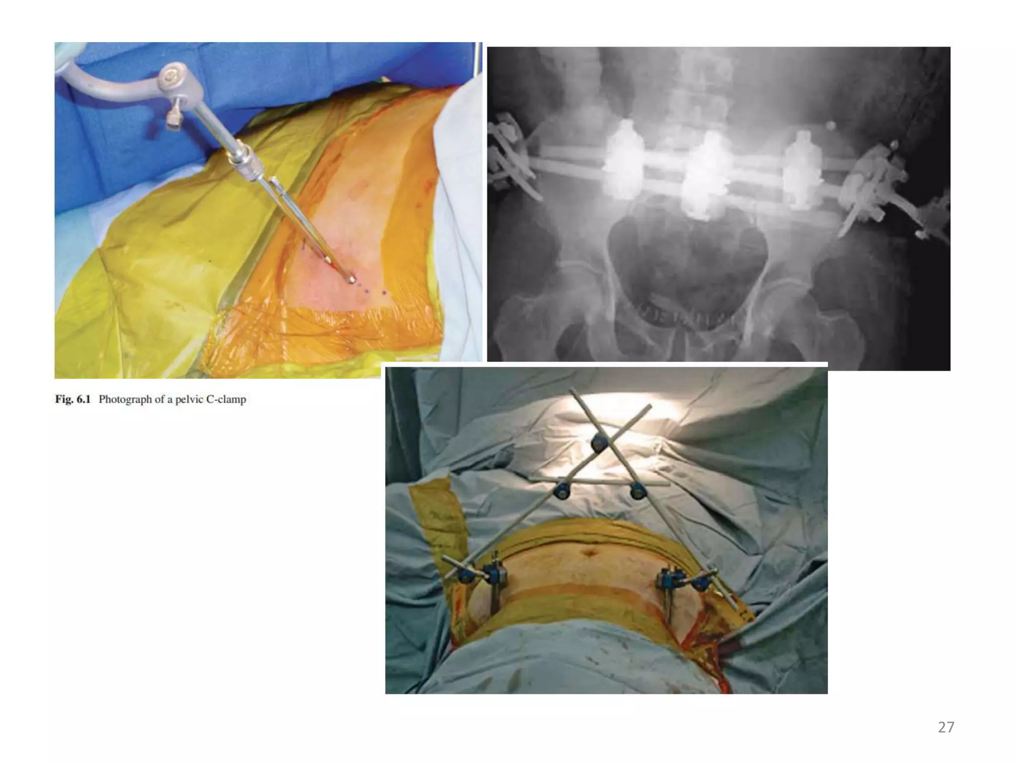 Damage Control Orthopedics and Principles of External Fixation.pptx