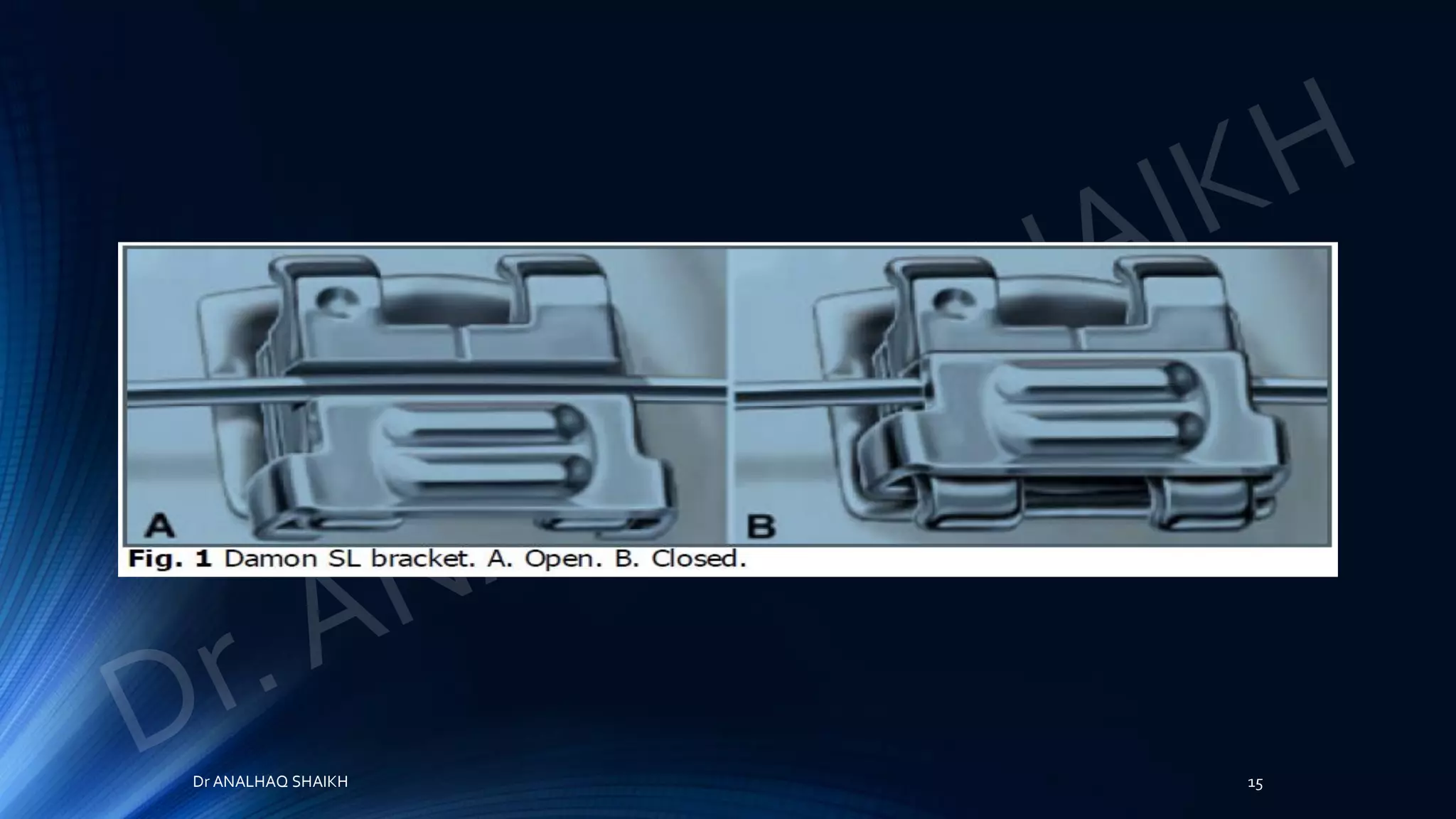 Damon system by Dr Analhaq Shaikh | PDF