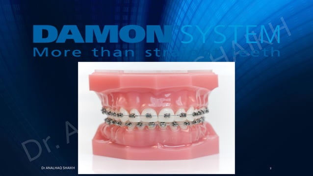 Damon system by Dr Analhaq Shaikh | PDF