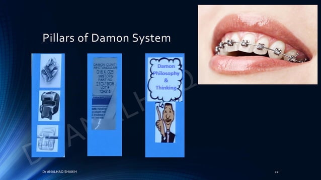 Damon system by Dr Analhaq Shaikh | PDF