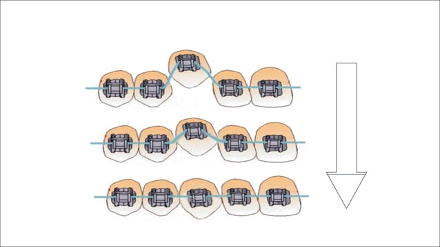 Damon system by Dr Analhaq Shaikh | PDF