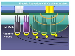Auditory & Developmental Neurophysiology: Cochlear Implants seminar | PPTX