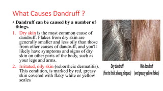 Dandruff | PPTX