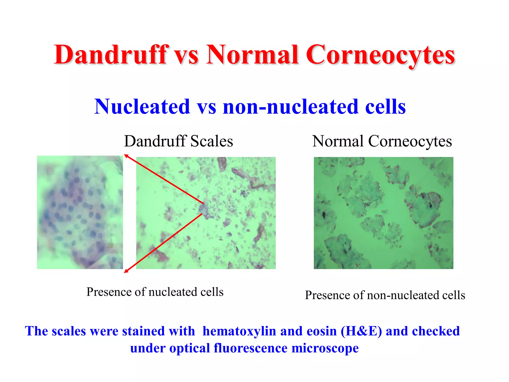 Dandruff vs normal corneocytes | PPT