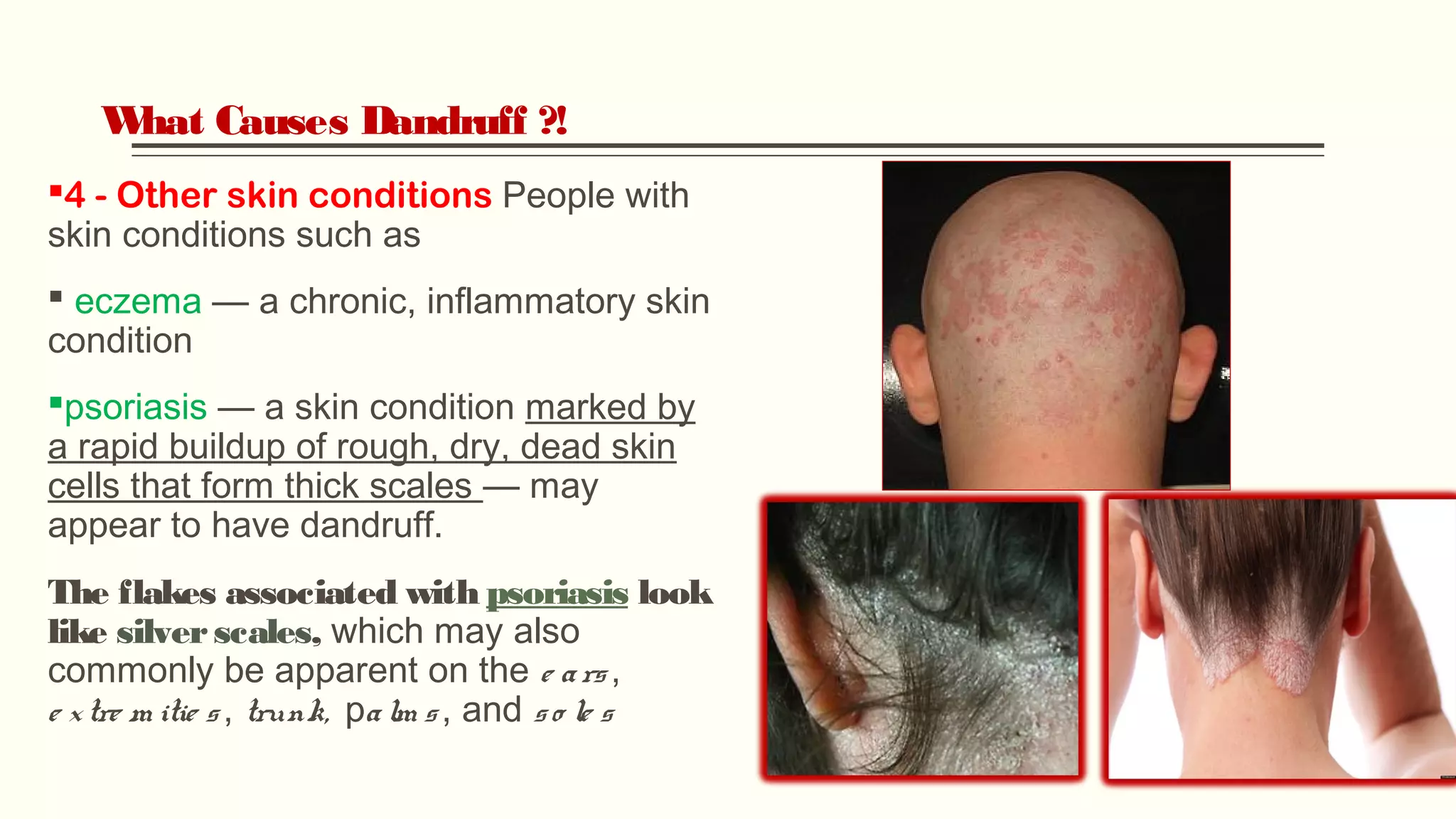 Dandruff | PPT