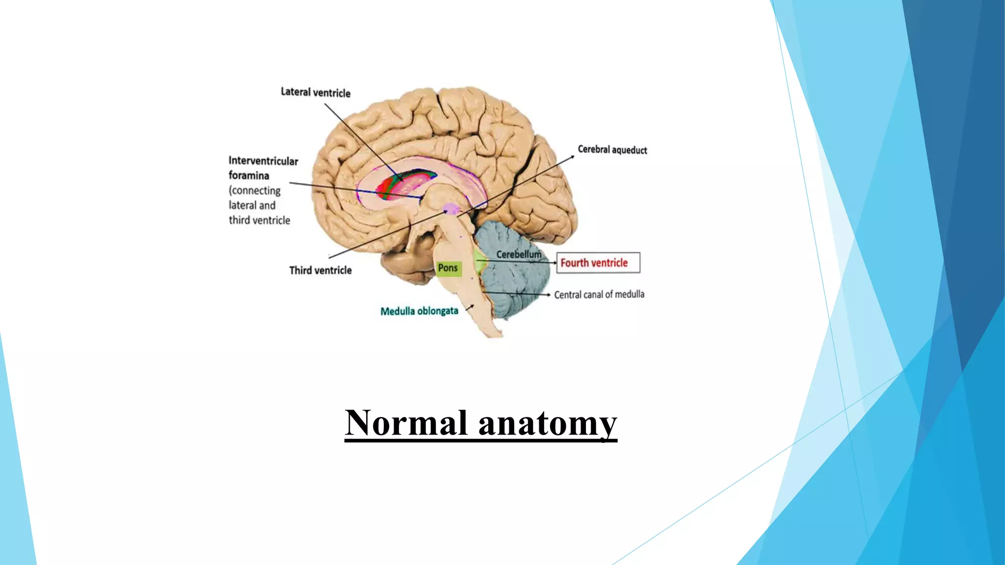 Dandy Walker Syndrome Ppt