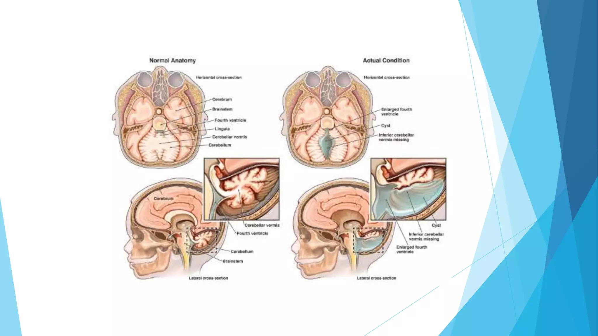 Dandy-Walker Syndrome | PPTX