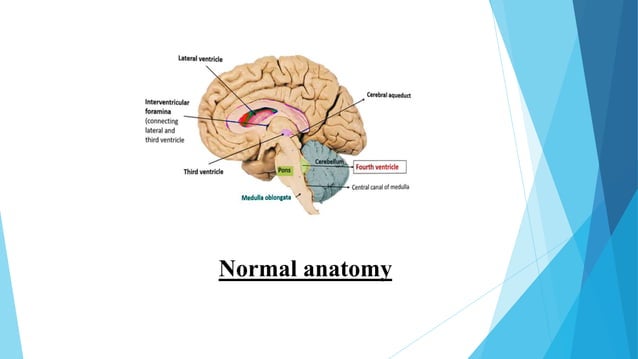 Dandy-Walker Syndrome | PPTX