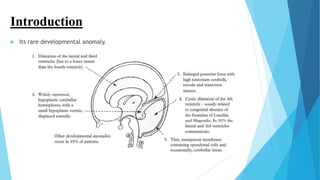 Dandy-Walker Syndrome | PPTX