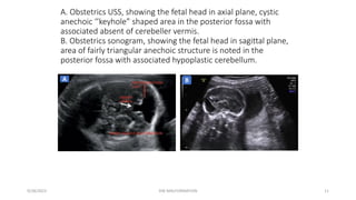 DANDYWALKER MALFORMATION | PDF