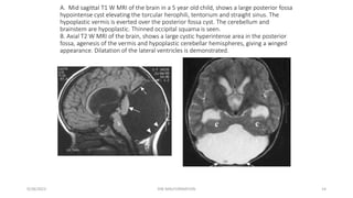 DANDYWALKER MALFORMATION | PDF