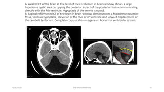 DANDYWALKER MALFORMATION | PDF
