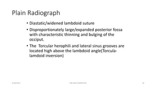 DANDYWALKER MALFORMATION | PDF
