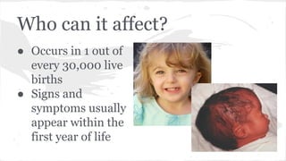 Dandy Walker Syndrome.pdf