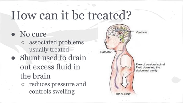 Dandy Walker Syndrome.pdf