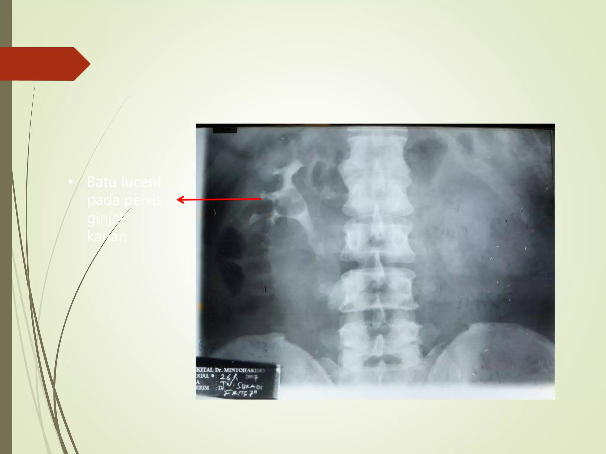 Danger of Kidney Stones.pptx