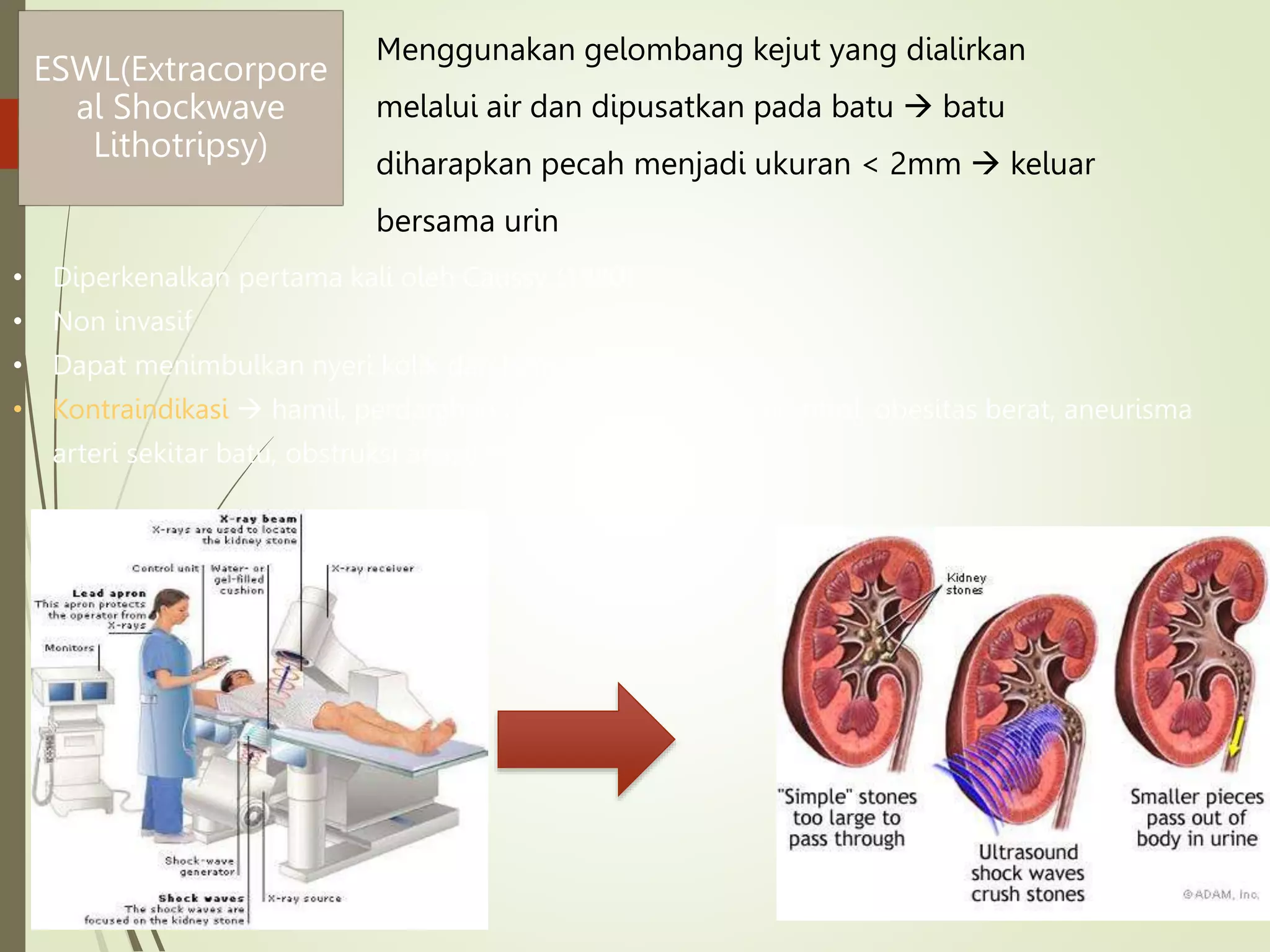 Danger of Kidney Stones.pptx