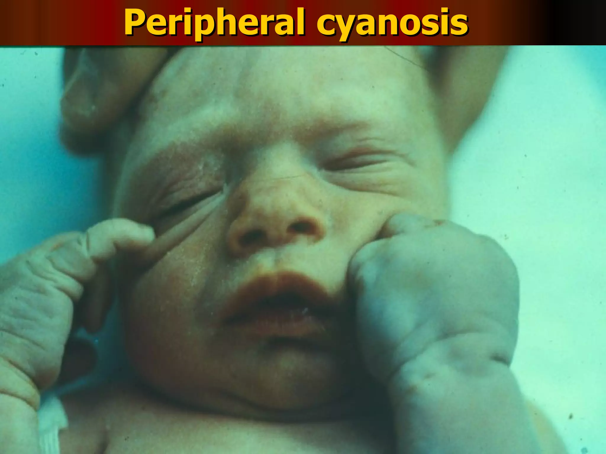 Danger signs in newborns | PPT