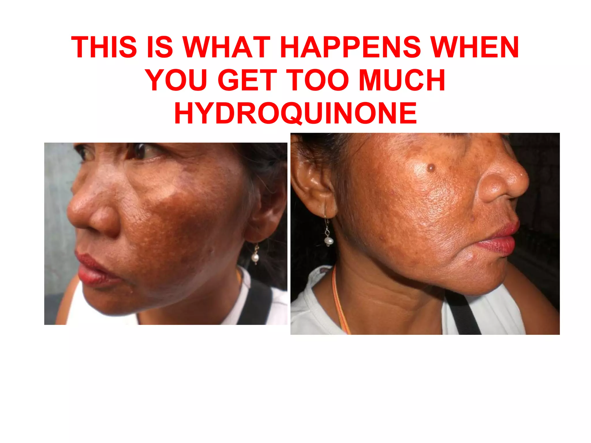 Dangers Of Hydroquinone | PPT