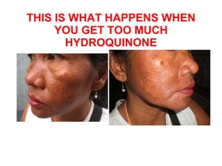 Dangers Of Hydroquinone | PPT