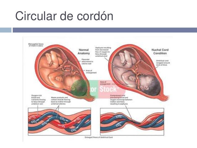 Accidentes de cordón umbilical