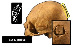 Ancient Trepanation & Brain Surgery in the Andes | PDF
