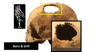 Ancient Trepanation & Brain Surgery in the Andes | PDF