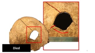 Ancient Trepanation & Brain Surgery in the Andes | PDF