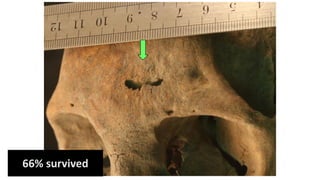 Ancient Trepanation & Brain Surgery in the Andes | PDF