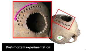 Ancient Trepanation & Brain Surgery in the Andes | PDF