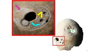 Ancient Trepanation & Brain Surgery in the Andes | PDF