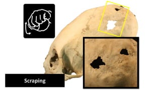 Ancient Trepanation & Brain Surgery in the Andes | PDF