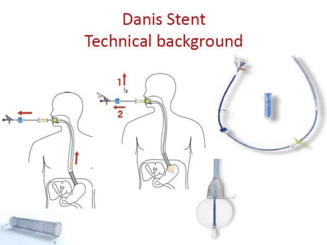 Ella Danis stent | PPTX | Digestive Disorders | Diseases and Conditions