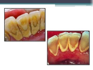 DANTAGATA ROGAH AND TEETH ANATOMY WITH AYURVEDIC DANTAGAT ROGA | PPTX